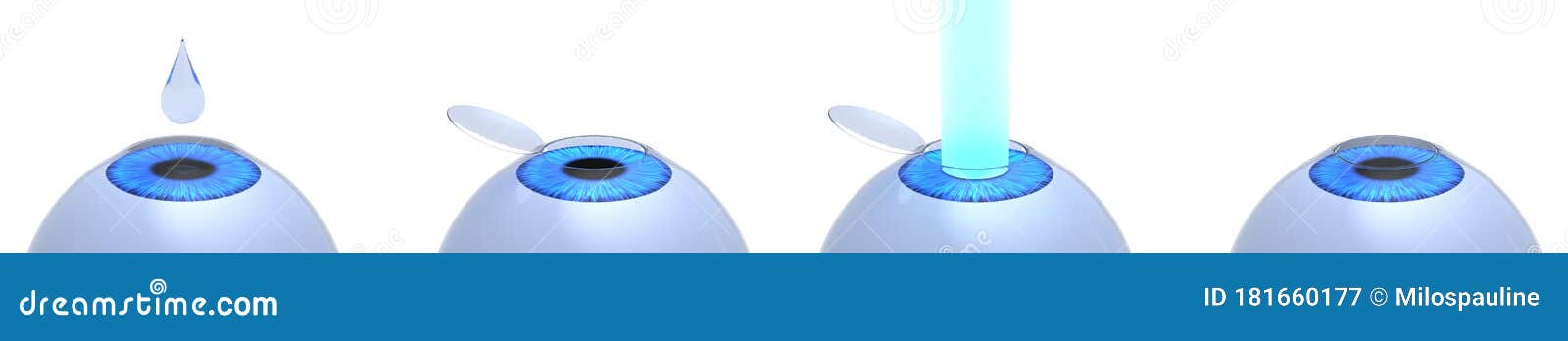 Laser Eye Surgery Procedure. 3D-rendering. Stock Illustration ...