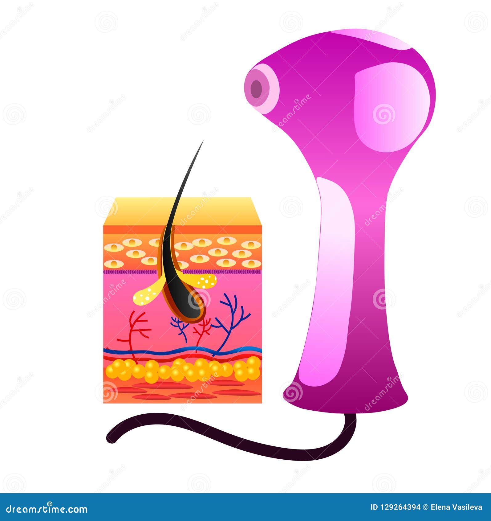 Laser Hair Removal, Structure of the Cell and a Laser Apparatus Stock ...