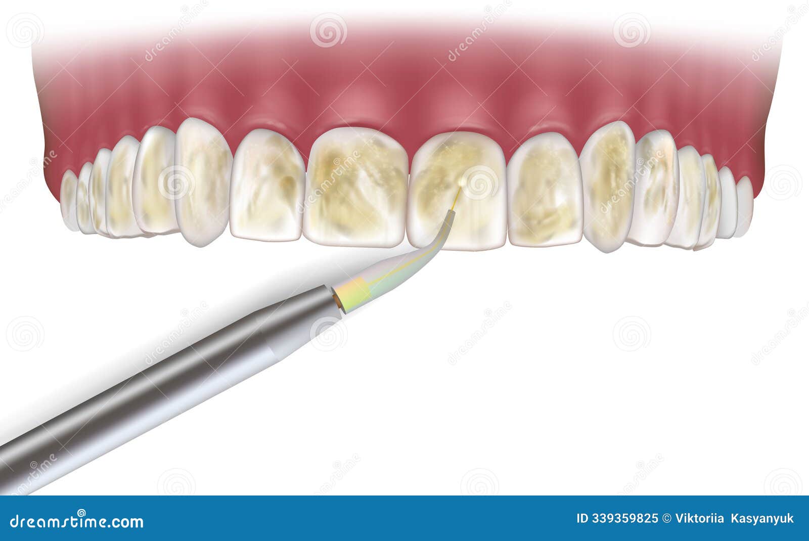 Dental Calculus Horisontal Medical Banner Template. Vector Illustration ...