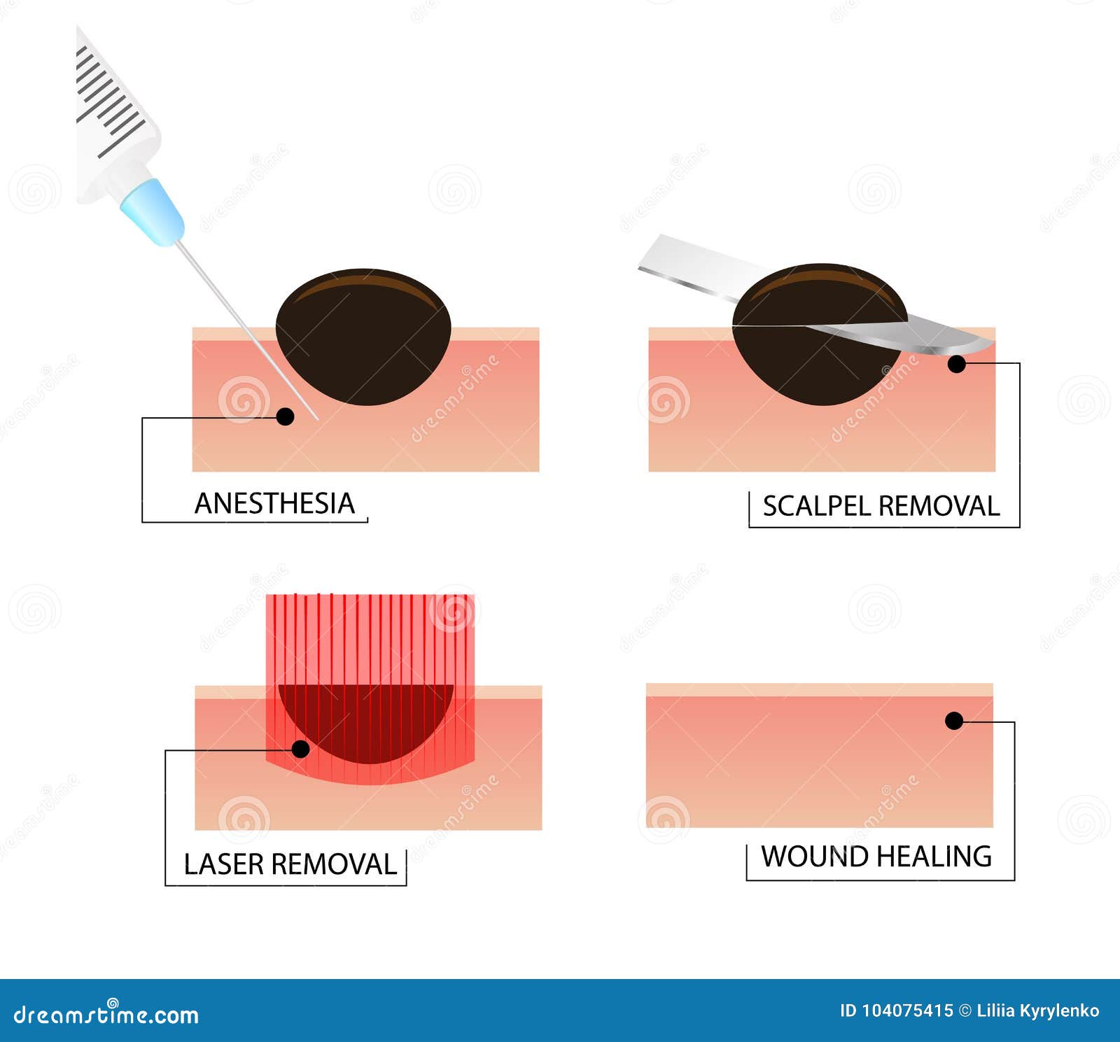 Birthmark Laser Removal. Nevus. Before And After Procedure. Removing ...