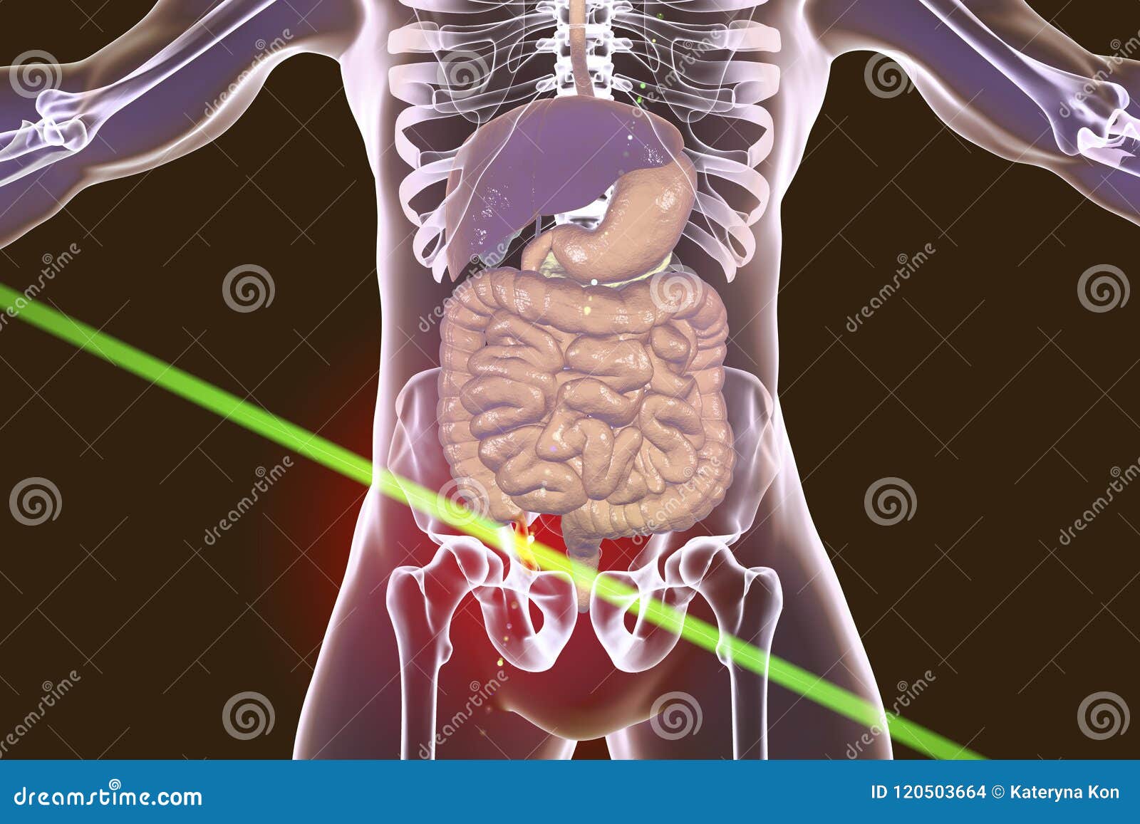 3d Illustration Of Appendicitis Concept Human Intestine Anatomy