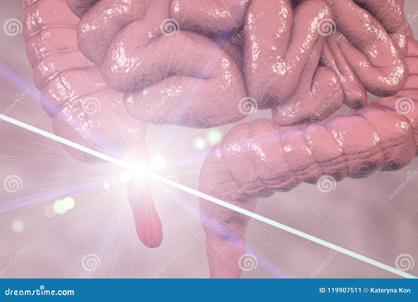 Acute Appendicitis Illustration Stock Illustration Illustration Of