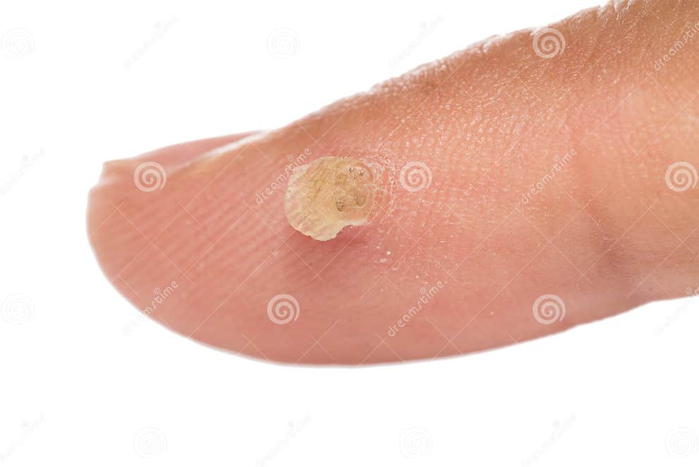 Last stage of verruca stock photo. Image of verruca, isolated - 30534266