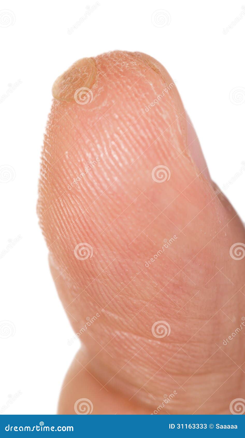 Last stage of verruca stock image. Image of view, isolated - 31163333