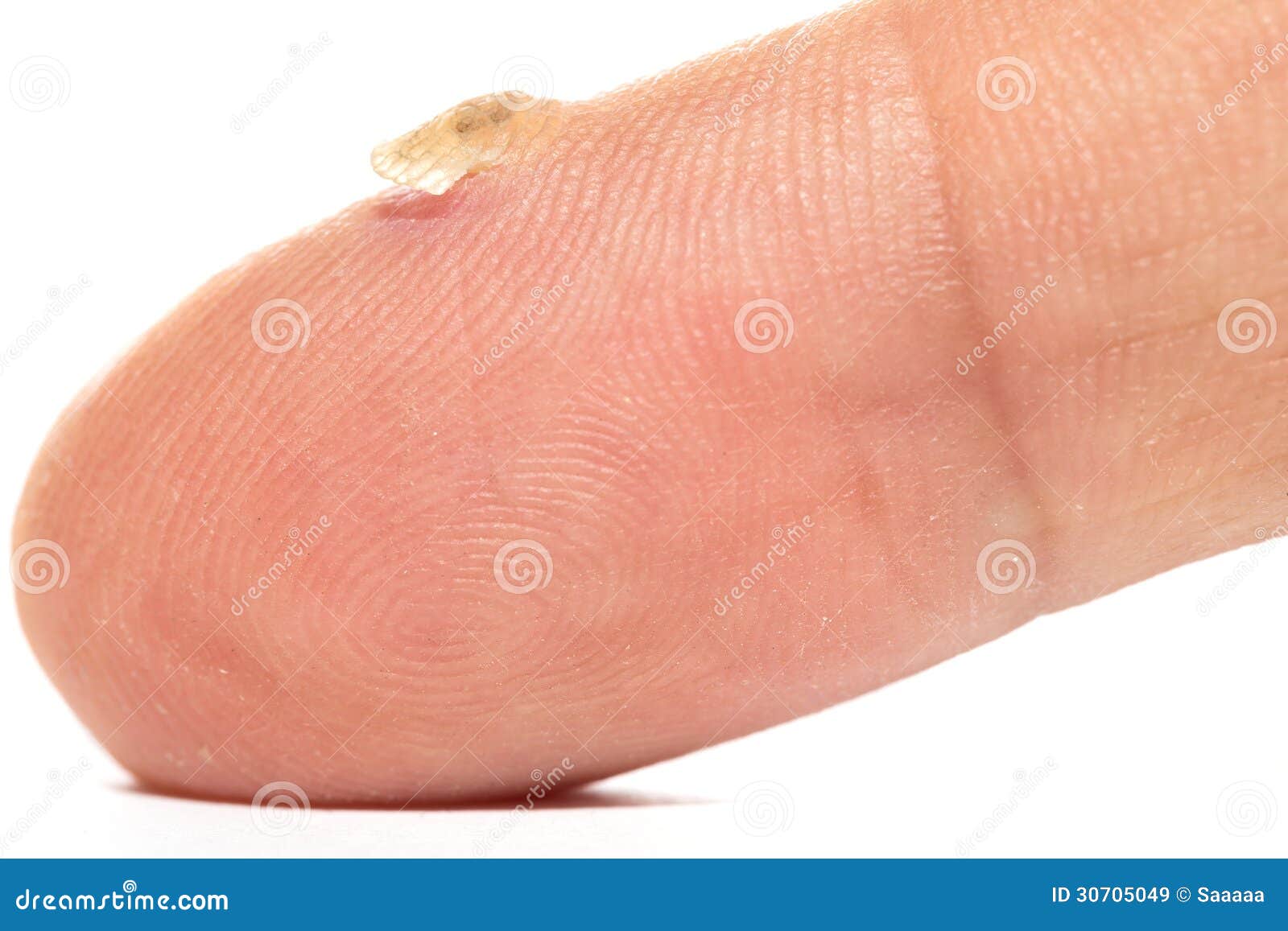 Last stage of verruca stock image. Image of quit, nitrogen - 30705049