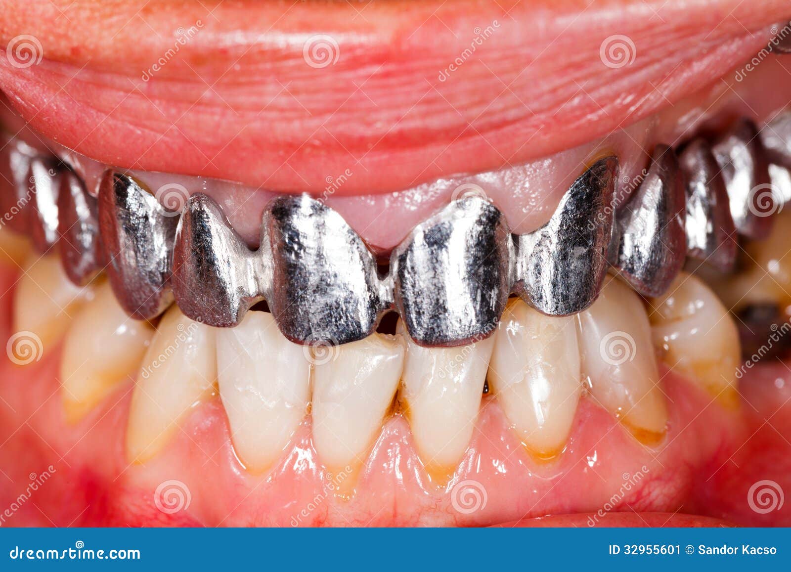 Last Step before Ceramic Layer Stock Image - Image of metallic, bridge ...