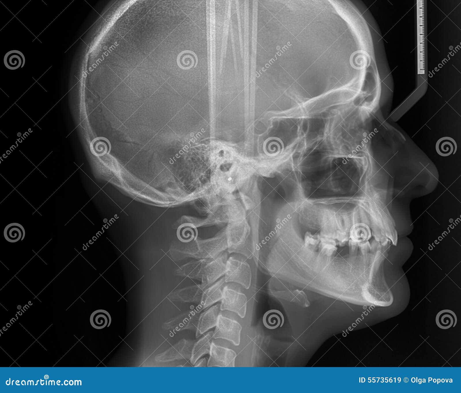 Lateral Cephalometric Radiograph Stock Image - Image of cephalometric ...