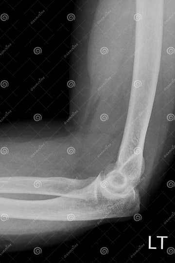 Lateral elbow x-ray stock image. Image of anatomy, vertical - 15325743