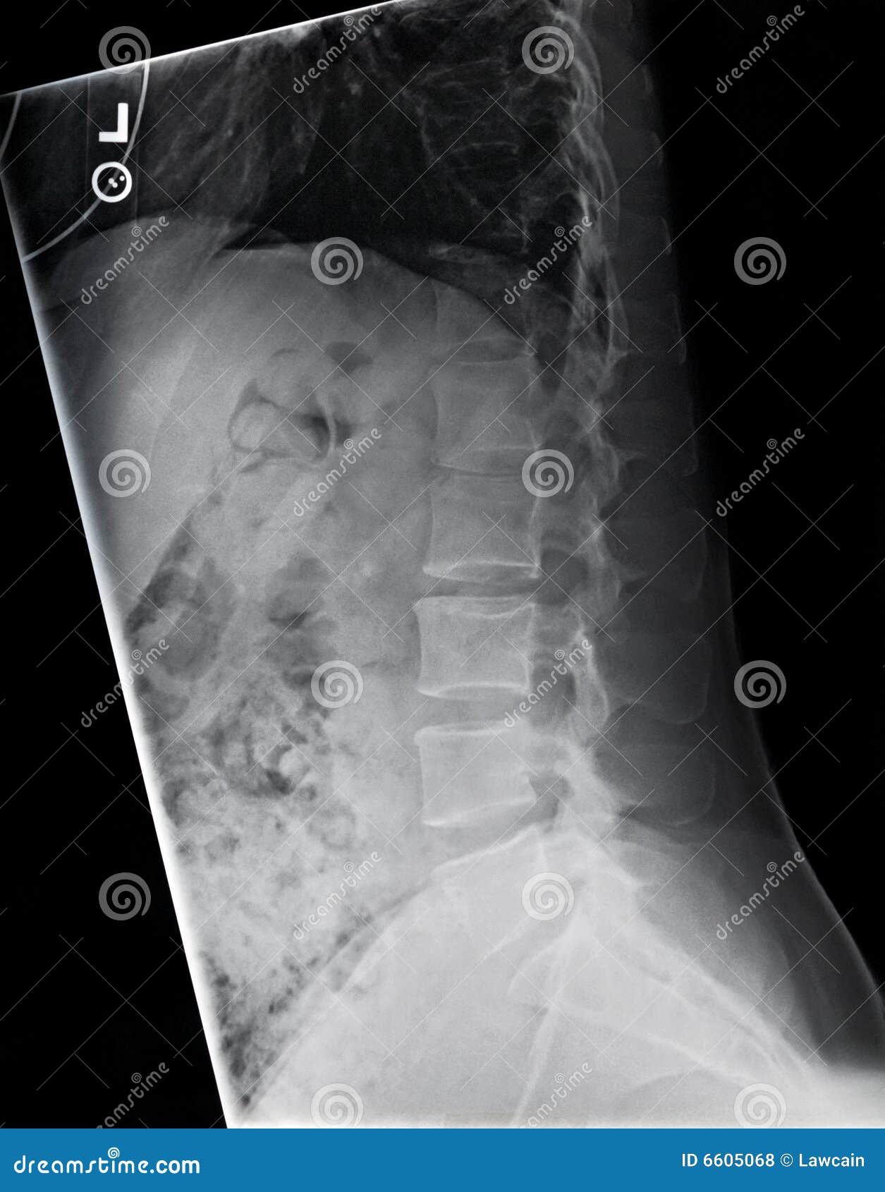 Xray, Lateral Lumbar Spine Royalty-Free Stock Image | CartoonDealer.com ...