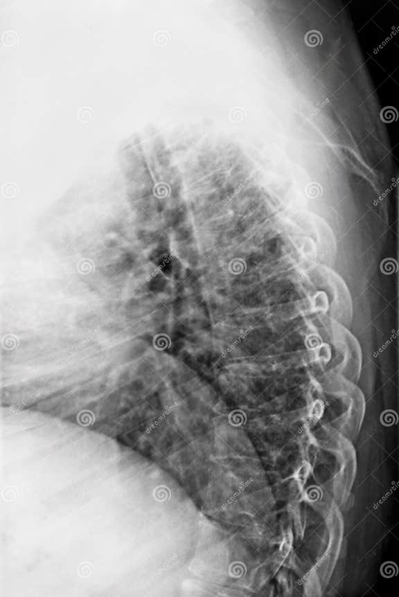 Lateral T-spine X-ray stock photo. Image of radiography - 7255282