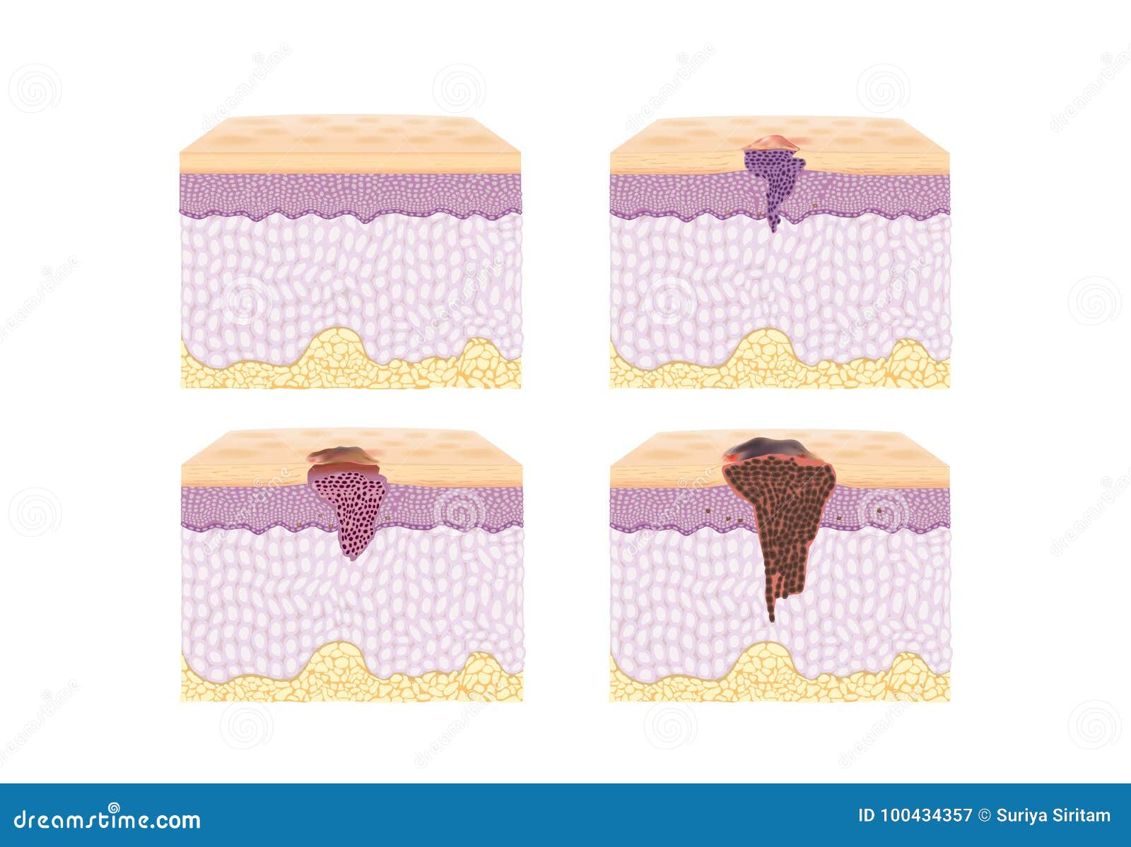 Layer of Normal Skin and Cancer Cell Spreading in Vector Style. Stock ...