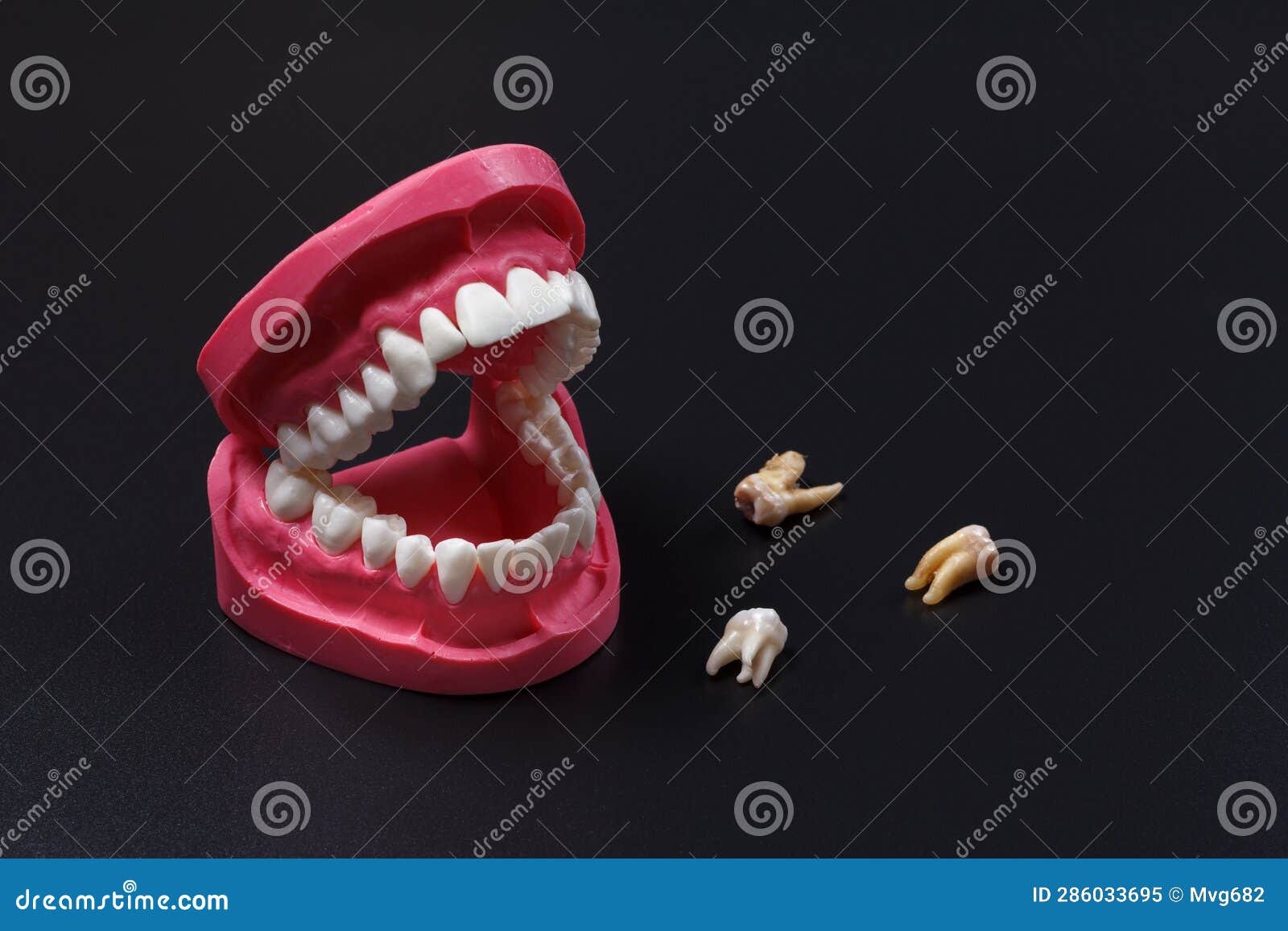 Extracted Human Teeth Royalty-Free Stock Photo | CartoonDealer.com ...