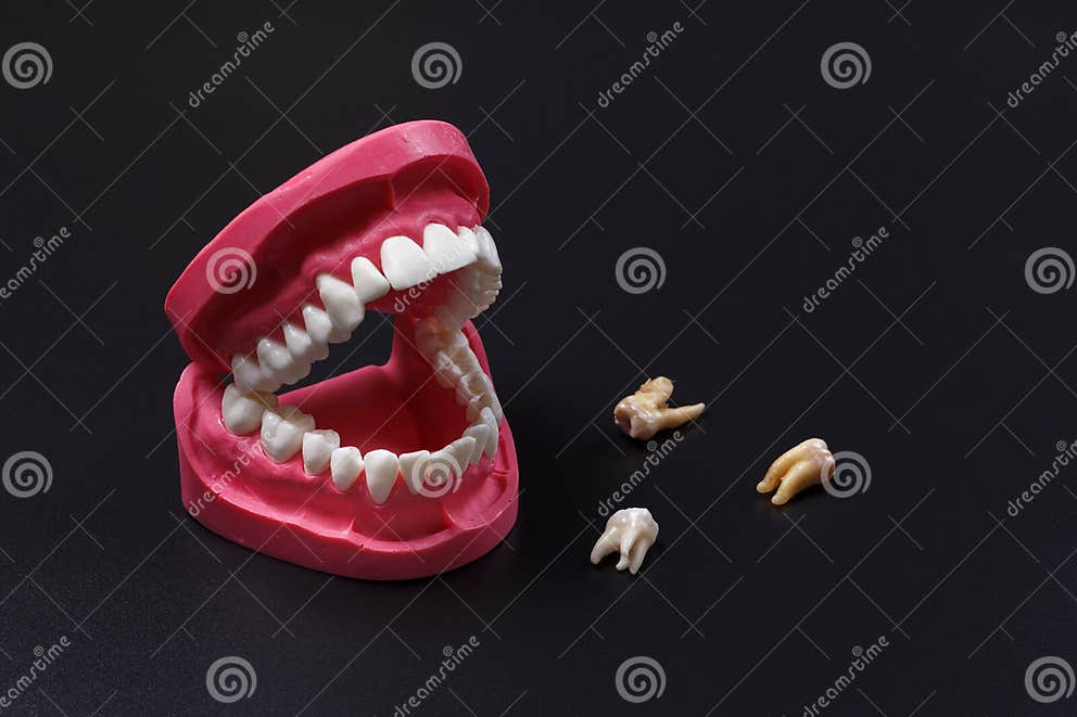 Layout of the Human Jaw and Extracted Sick Teeth Stock Image - Image of ...
