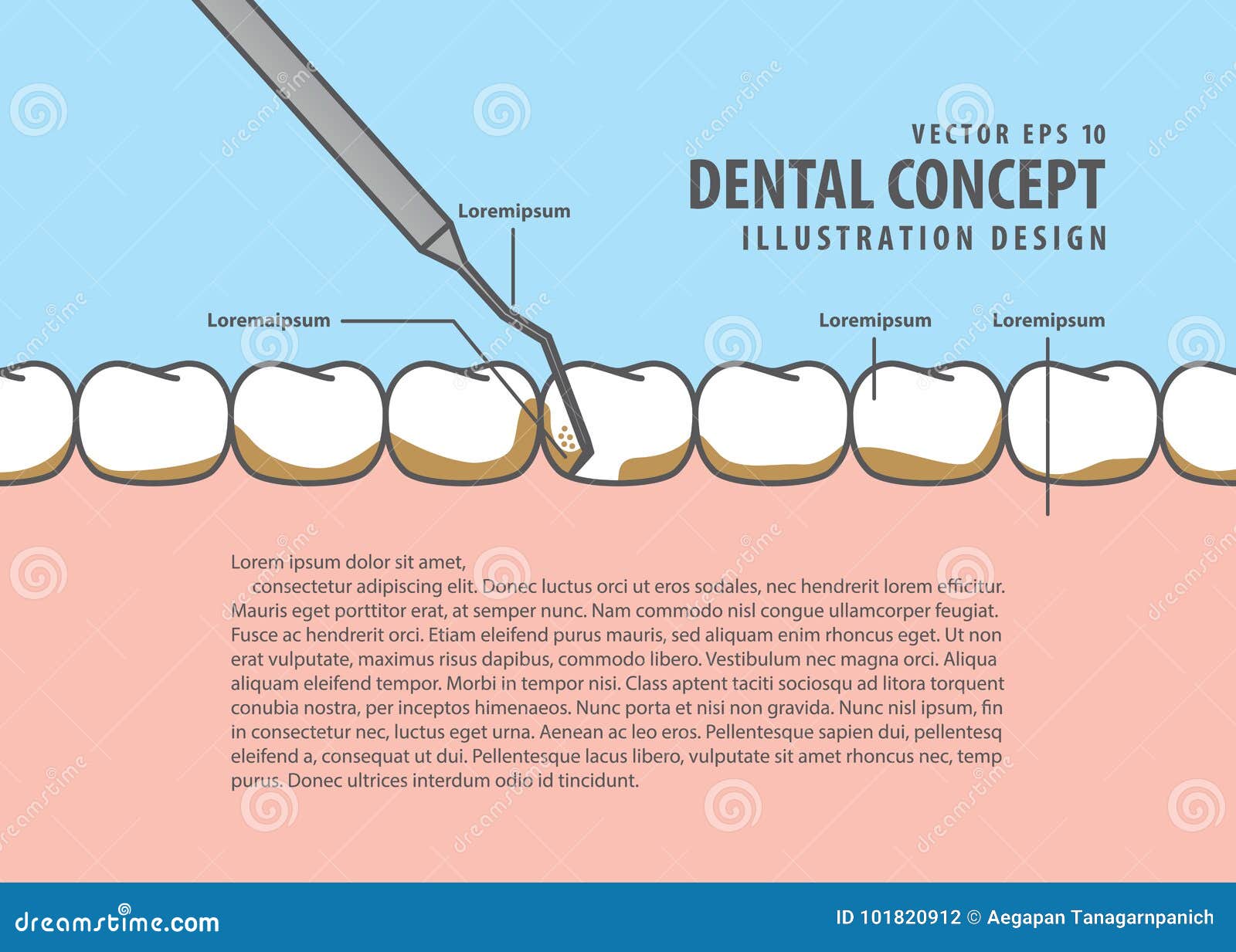Layout Scaling Teeth Illustration Vector on Blue Background. Den Stock ...