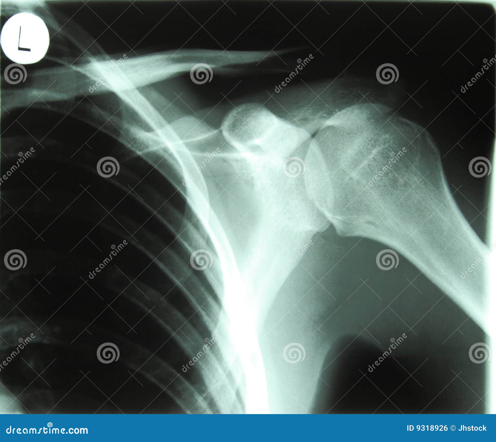 Le rayon X est parti photo stock. Image du diagnostique - 9318926