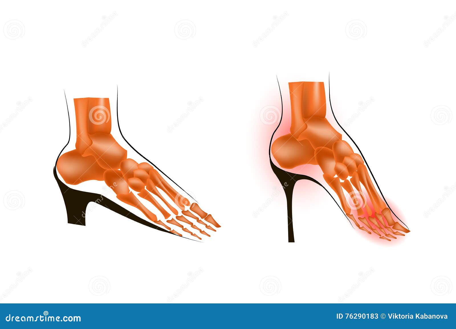 Le Squelette Du Pied Est Bas Et Un Talon Haut Illustration de Vecteur ...