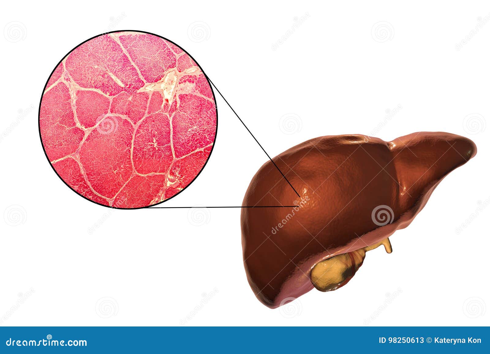 Leberillustration Und -mikrograph Stock Abbildung - Illustration von hepatitis, organ: 98250613