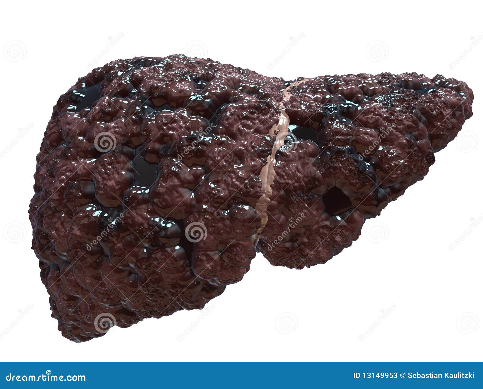 Leberzirrhose stock abbildung. Illustration von fetthaltig - 13149953