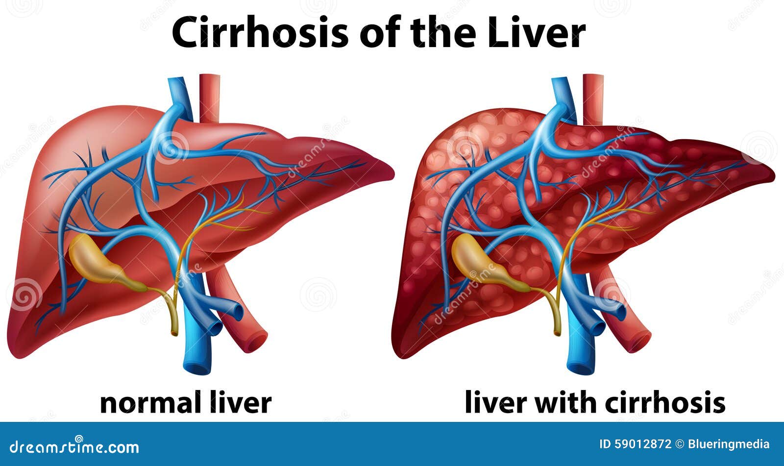 Leberzirrhoseplakat vektor abbildung. Illustration von biologie - 59012872
