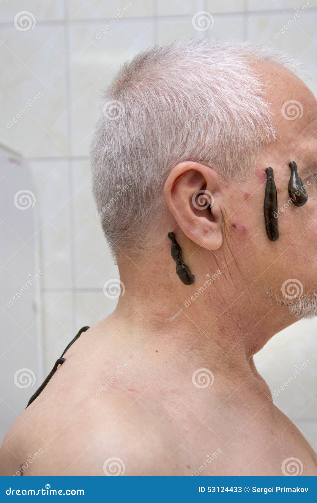 Leech therapy stock image. Image of therapy, person, lastone - 53124433