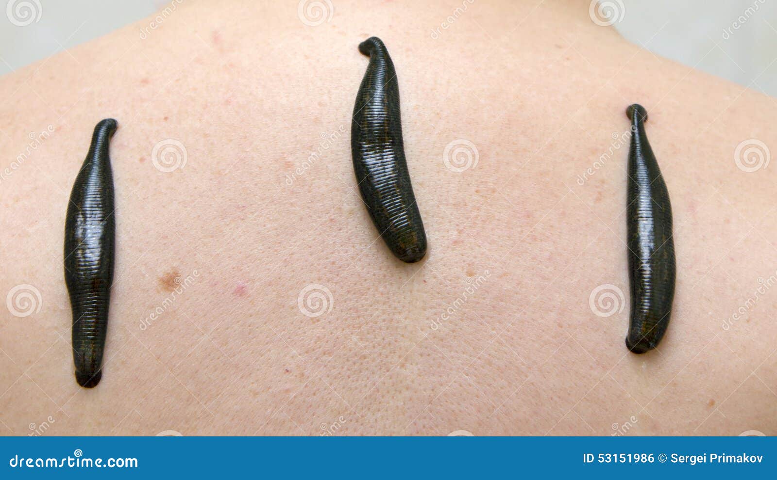 Leech therapy stock photo. Image of pampering, body, wellness - 53151986