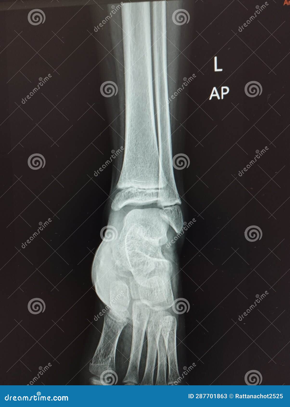 Left Ankle X-ray Lateral View Normal Bone and No Swelling Soft Tissue ...