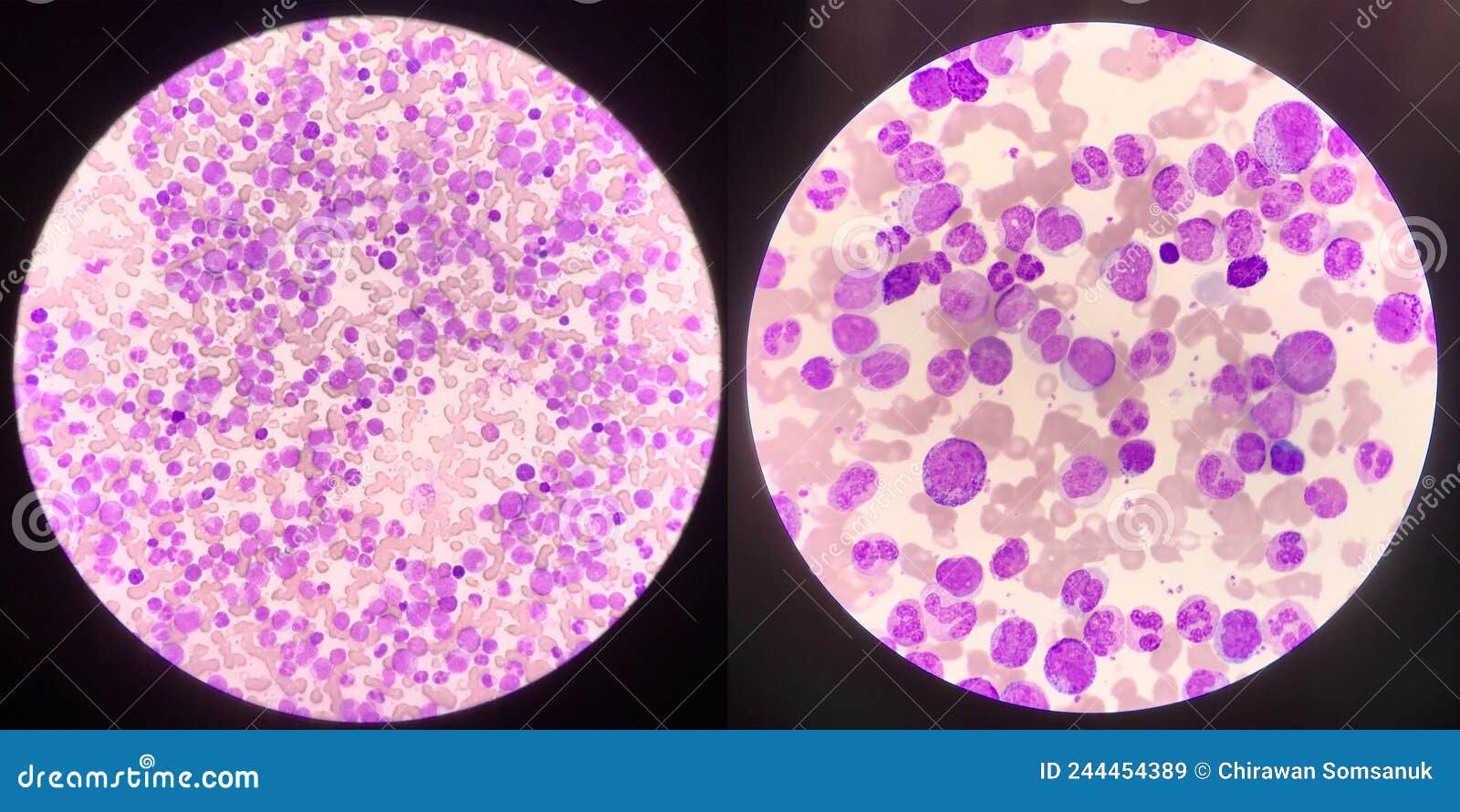 Left Anormal Blood Smear 40x Microscope,Right Anormal Blood Smear 100x ...