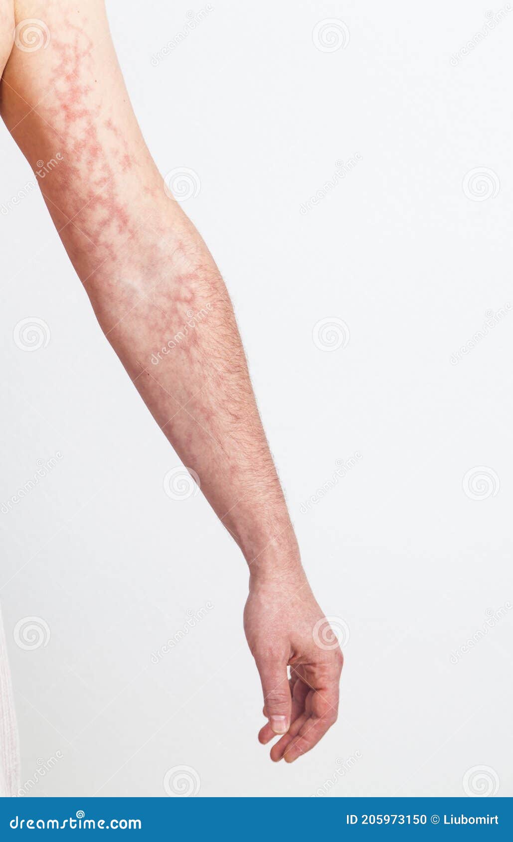 Left Arm with Red Skin Capillary Network Stock Photo - Image of male ...