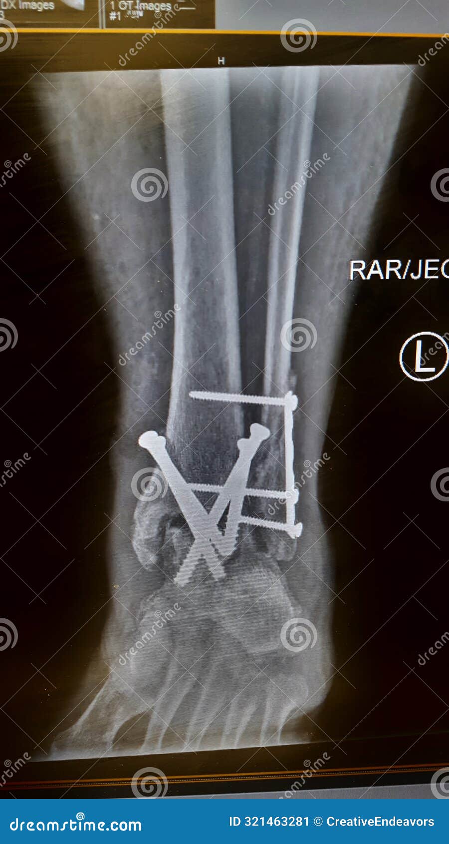 Left Foot Ankle Replacement Hardware - Plain X Ray Stock Image - Image ...