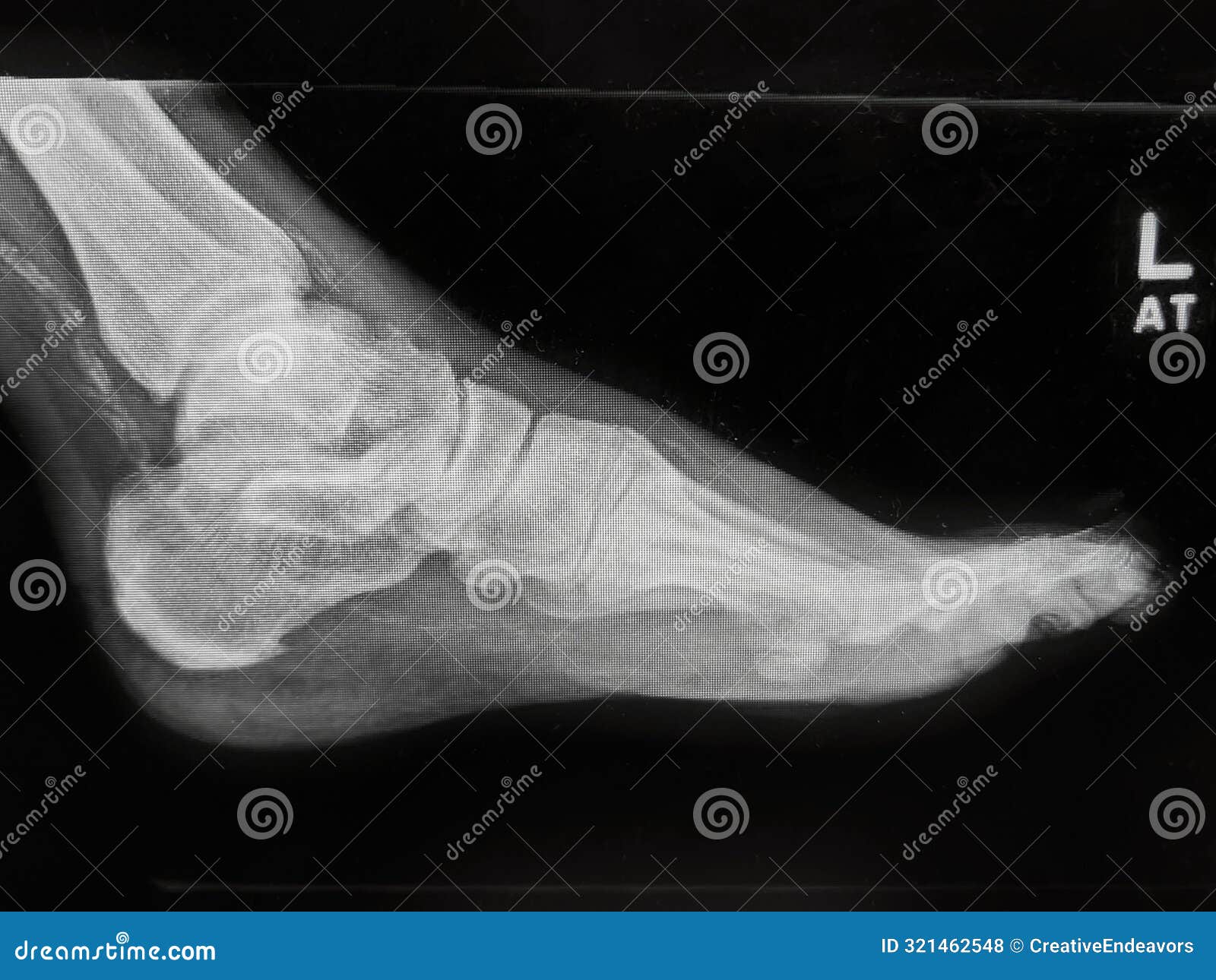 Left Foot Normal Radiograph - Plain X Ray Stock Photo - Image of trauma ...