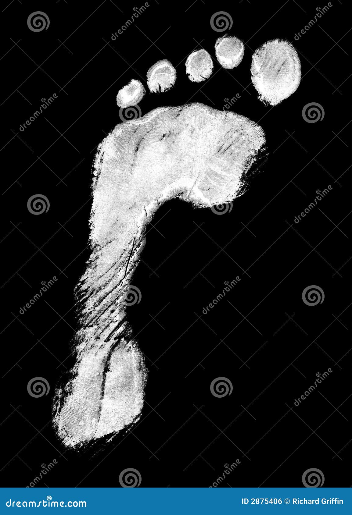 Left Foot Transmetatarsal Amputation Stump - MRI Image Royalty-Free ...