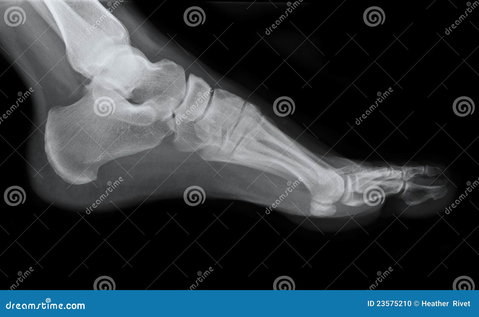 Left Foot Side X-Ray stock photo. Image of bones, imaging - 23575210