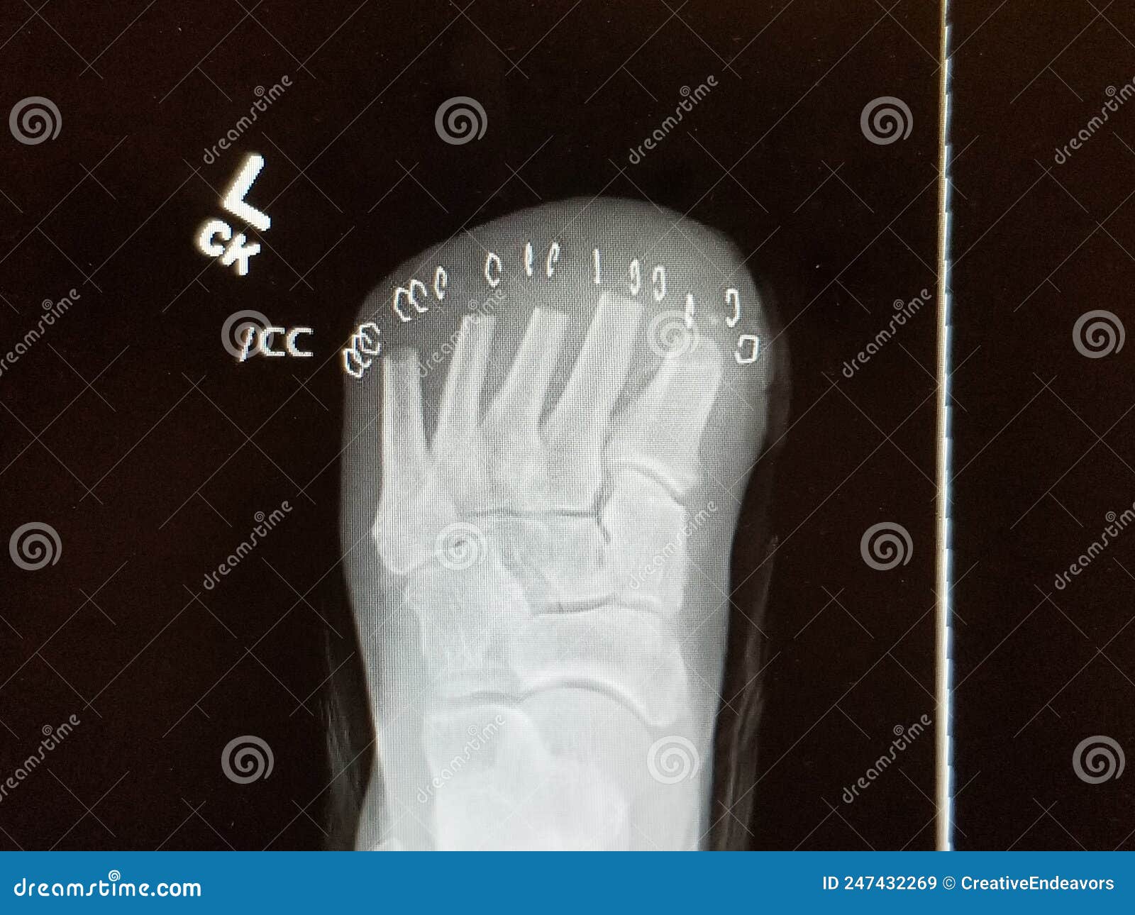 Left Foot Transmetatarsal Amputation with Staples - Plain X-ray Stock ...