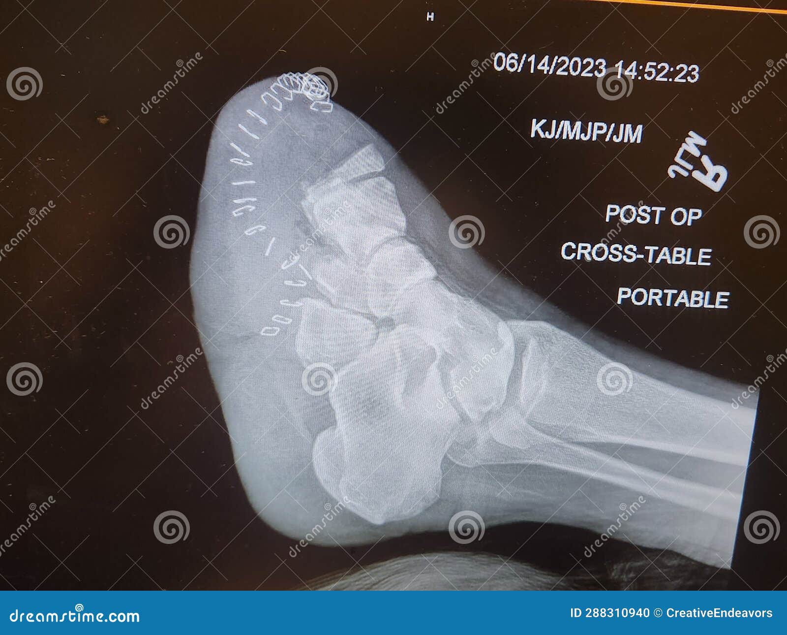 Left Foot Transmetatarsal Amputation With Staples - Plain X-ray Stock ...