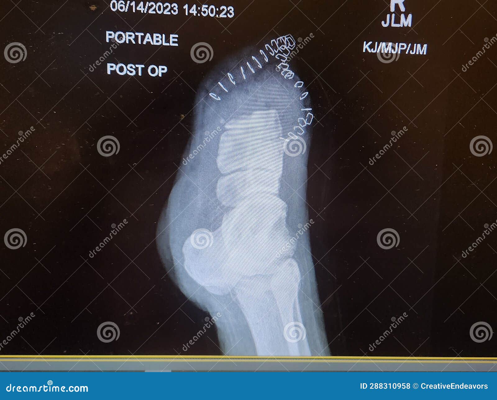 Left Foot Transmetatarsal Amputation With Staples - Plain X-ray Stock ...
