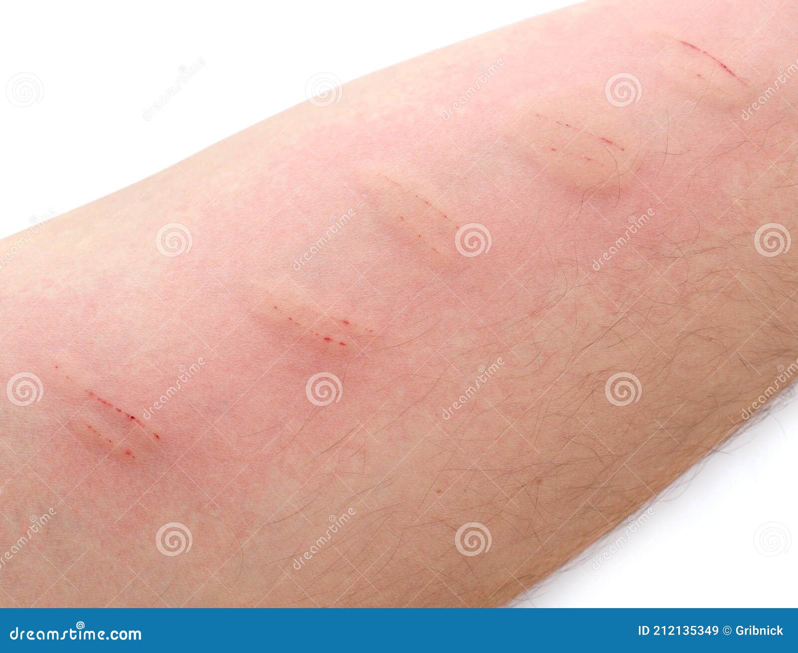 Left forearm allergy test stock image. Image of illness - 212135349