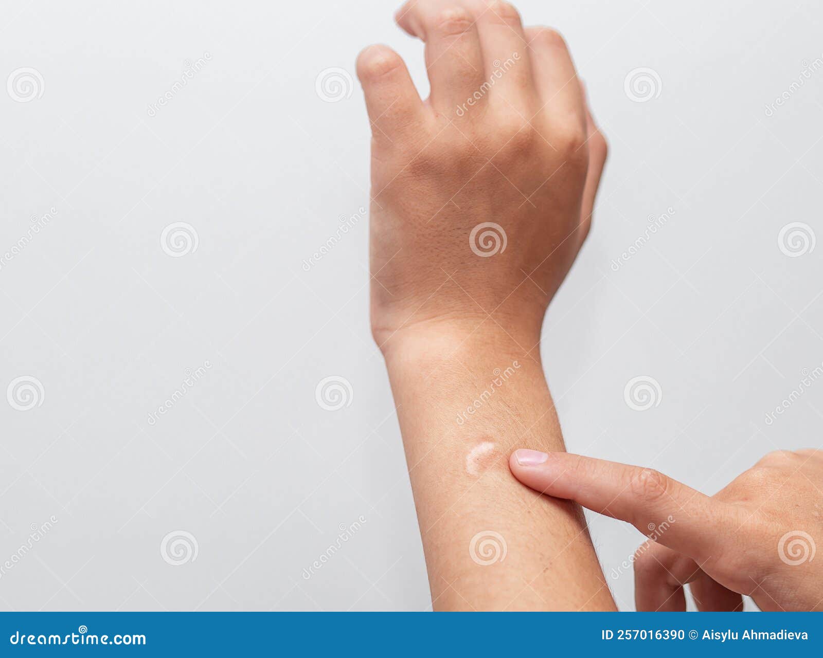 Hand With Scar Due To Scaphoid Bone Fracture. White Background. Royalty ...