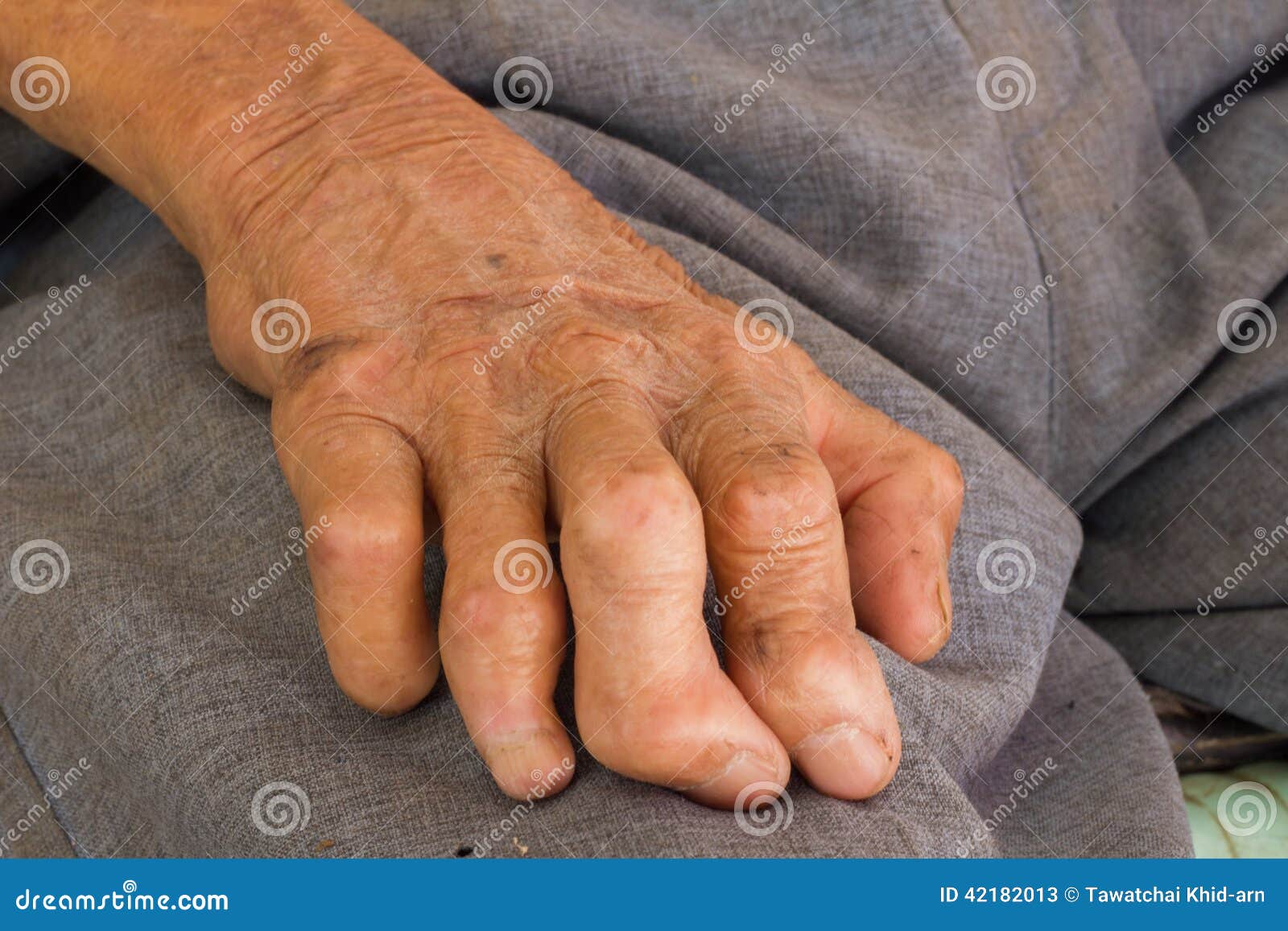 Hand With Interdigital Dermatitis, Dyshidrotic Eczema On Hand Close Up ...