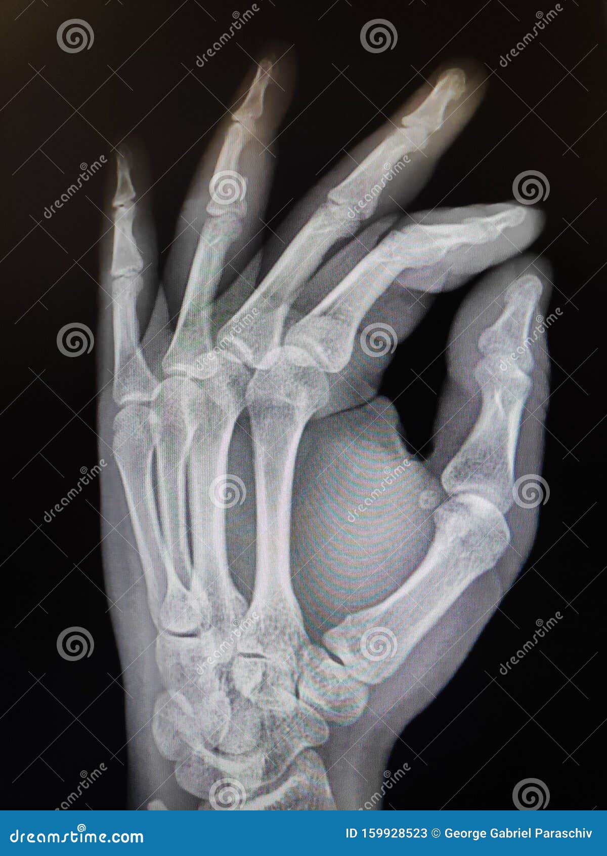 Left Hand X-Ray 4th Finger Broken Stock Image - Image of finger ...