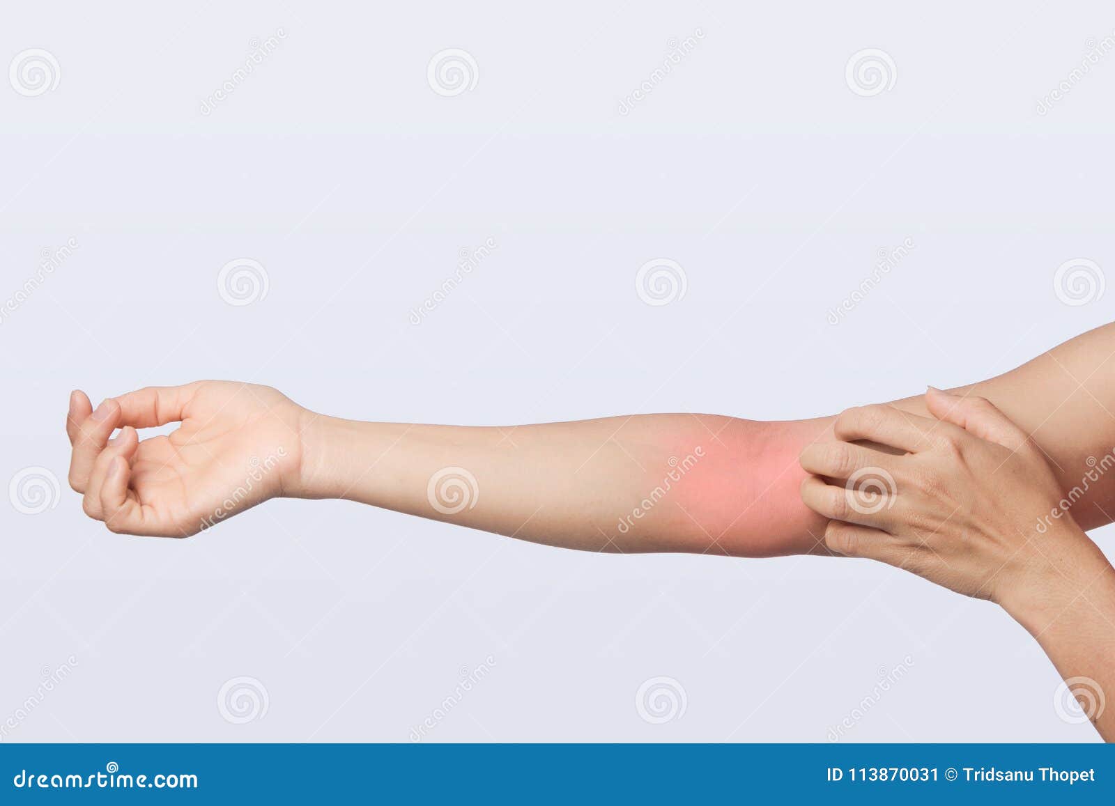 Rash at elbow joint stock image. Image of medicine, condition - 113870031