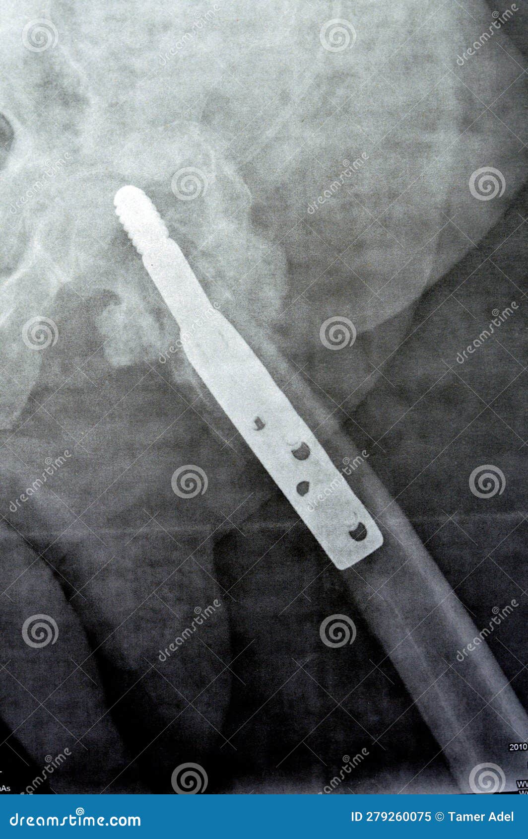 Left Hip Trans Cervical Neck Of Femur Fracture Fixated By Dhs Dynamic Hip Screw Plain X Ray Pxr