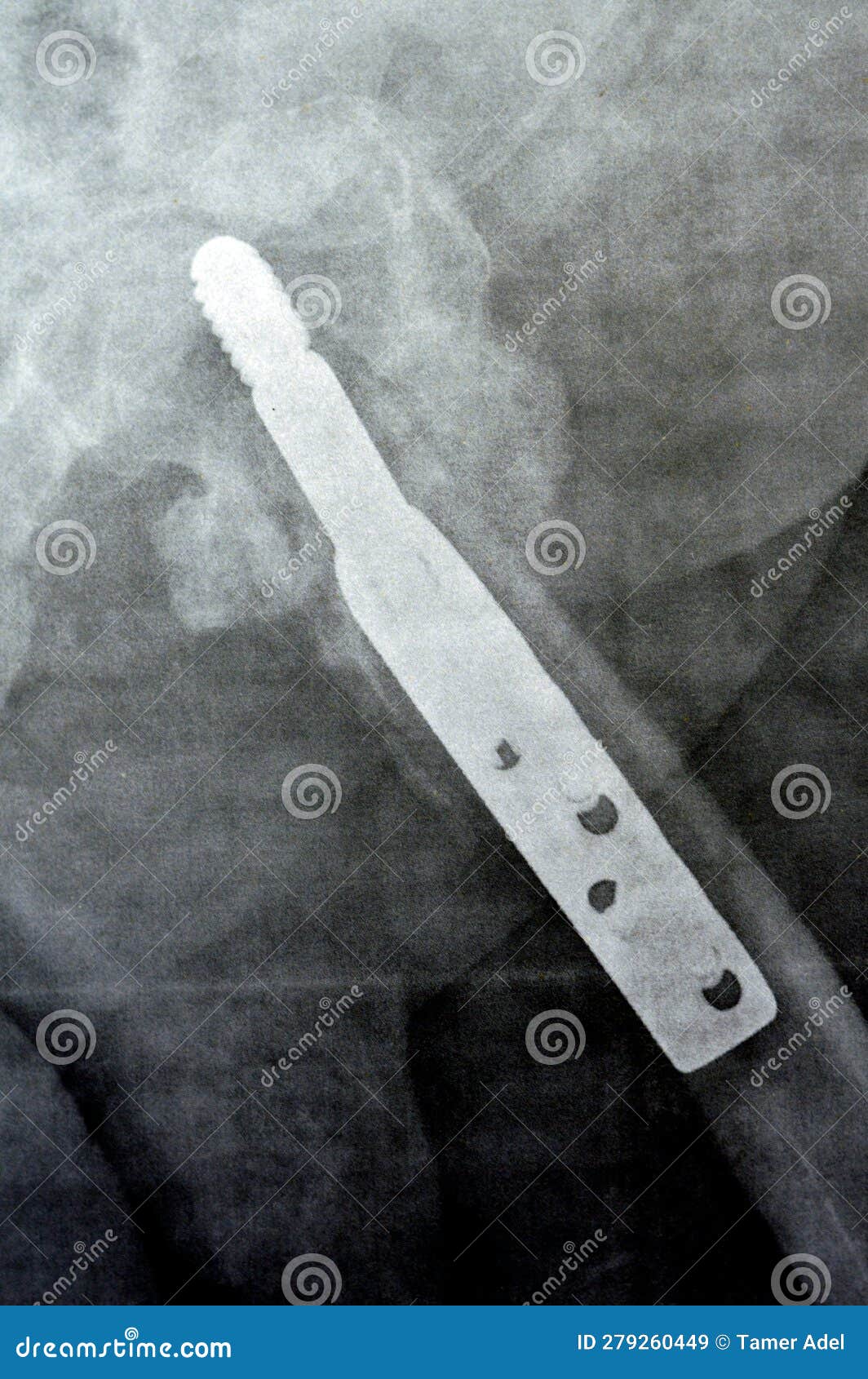 Left Hip Trans Cervical Neck Of Femur Fracture Fixated By Dhs Dynamic Hip Screw Plain X Ray Pxr