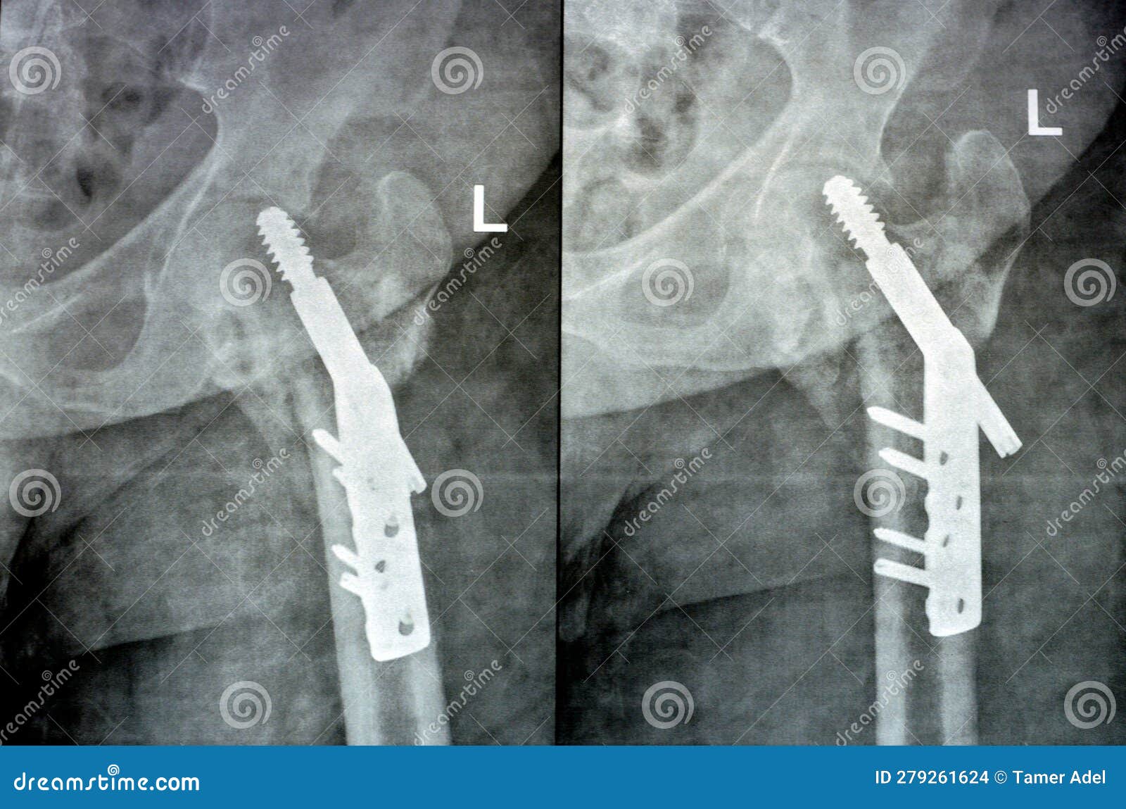 Left Hip Trans Cervical Neck Of Femur Fracture Fixated By Dhs Dynamic Hip Screw Plain X Ray Pxr