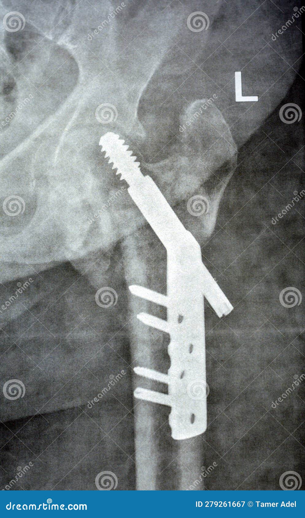 Left Hip Trans Cervical Neck Of Femur Fracture Fixated By Dhs Dynamic Hip Screw Plain X Ray Pxr