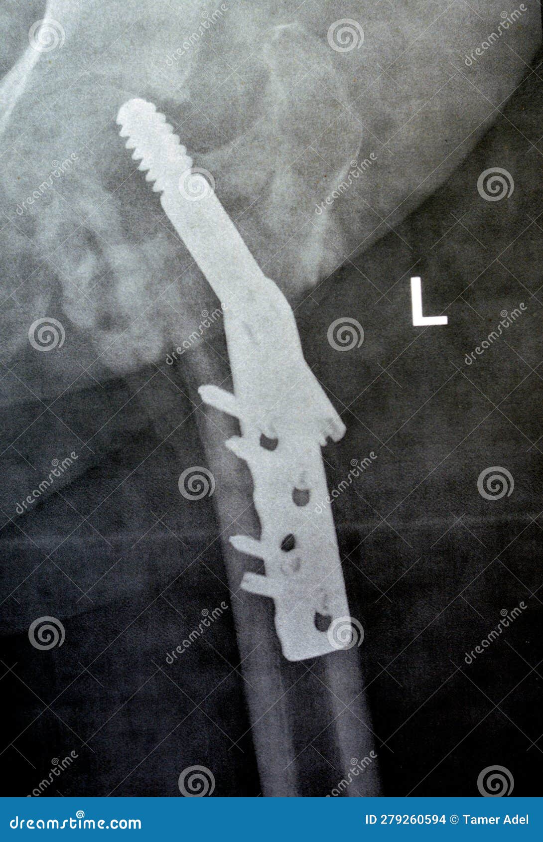 Left Hip Trans Cervical Neck Of Femur Fracture Fixated By Dhs Dynamic Hip Screw Plain X Ray Pxr