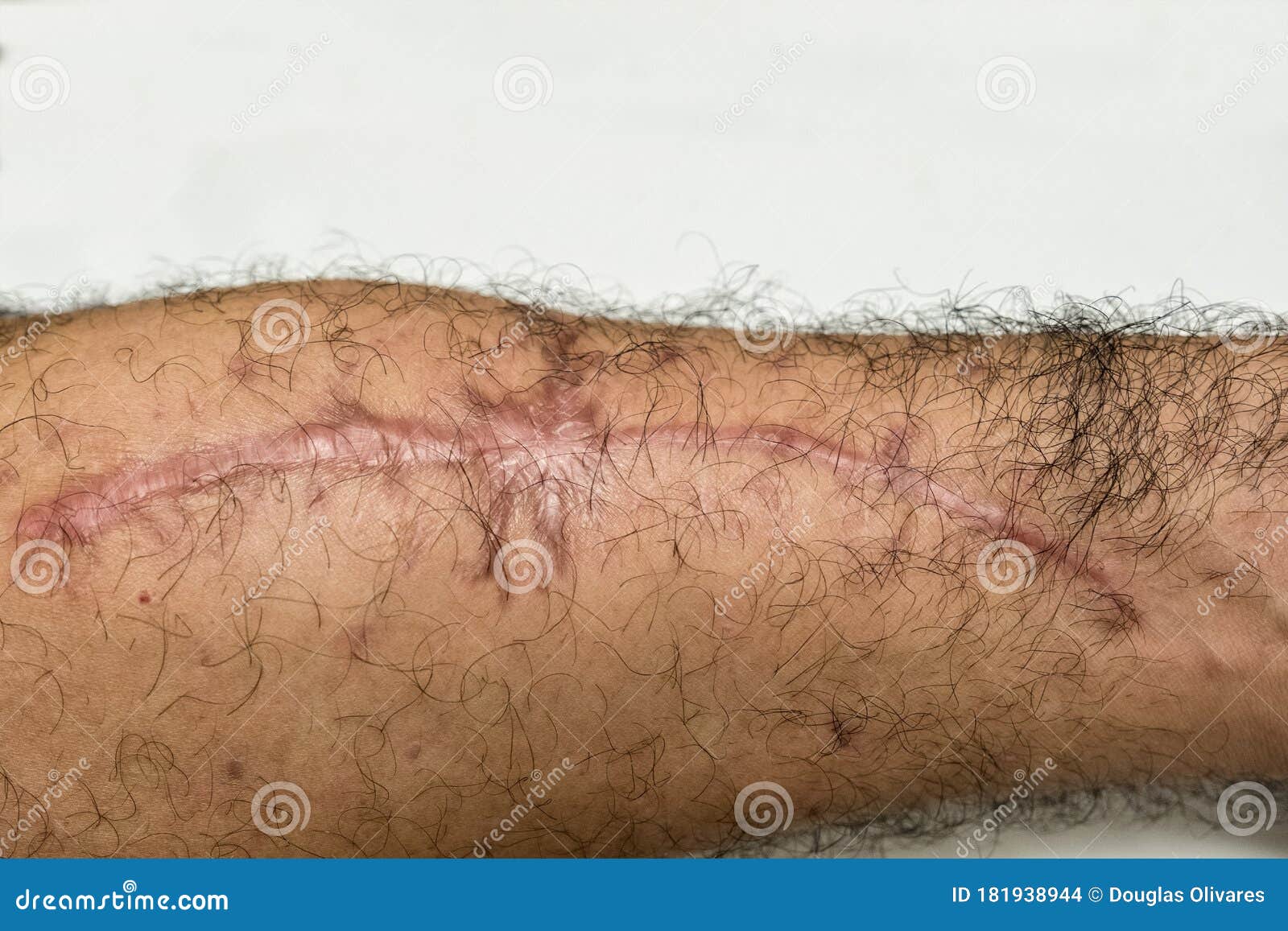 Left leg surgical scar stock photo. Image of lote, examination - 181938944