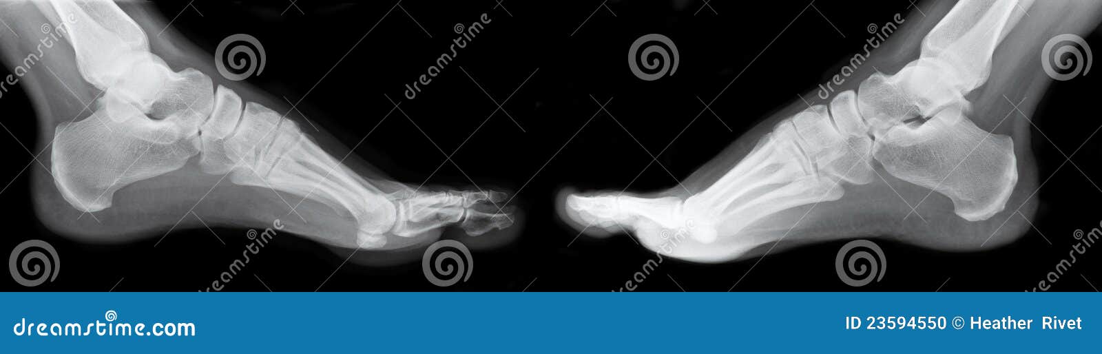 Normal Foot Xray Lateral