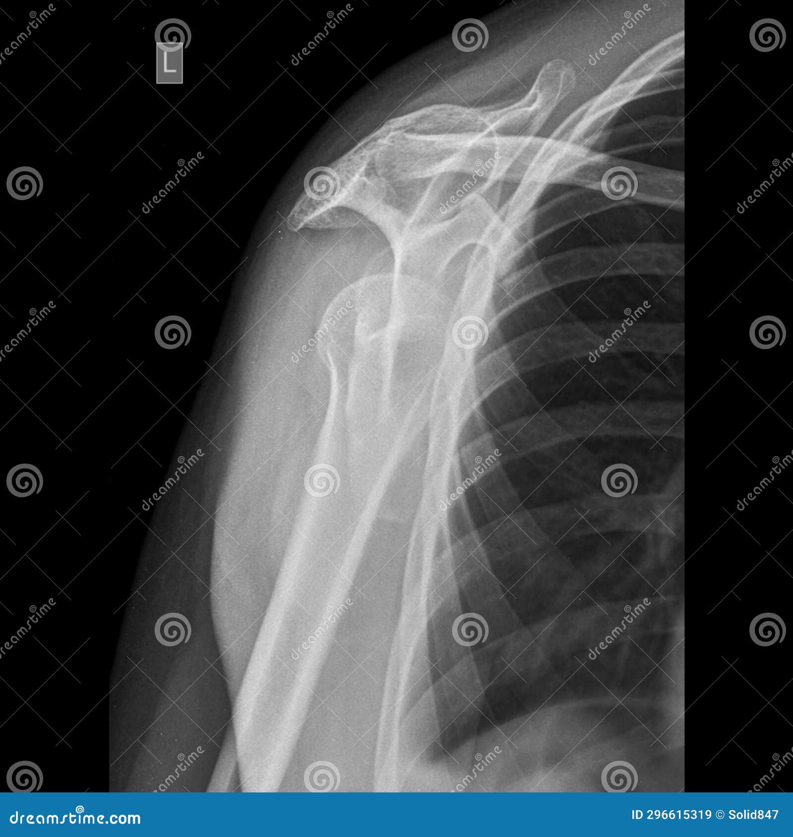 Scapula Lateral View Stock Photo | CartoonDealer.com #81729234