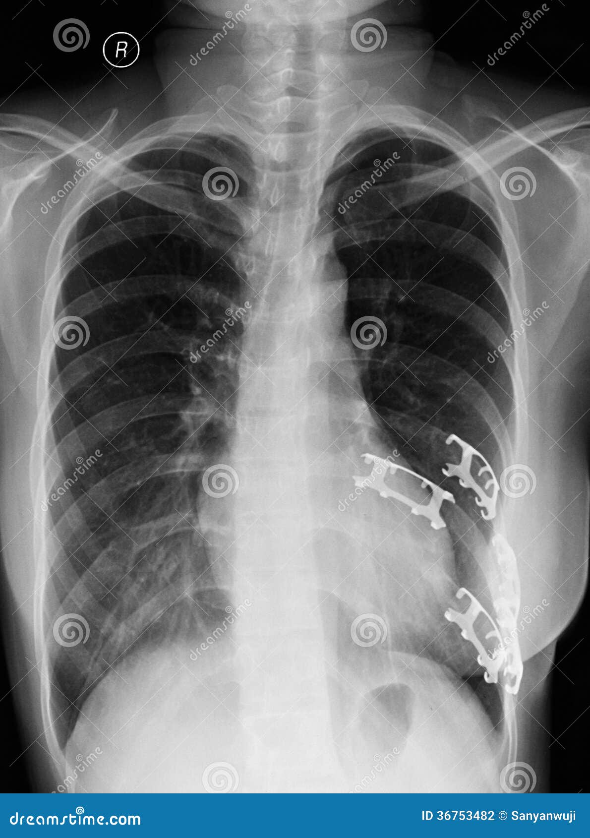 Rib Fracture Under Left Breast at Kate Gates blog