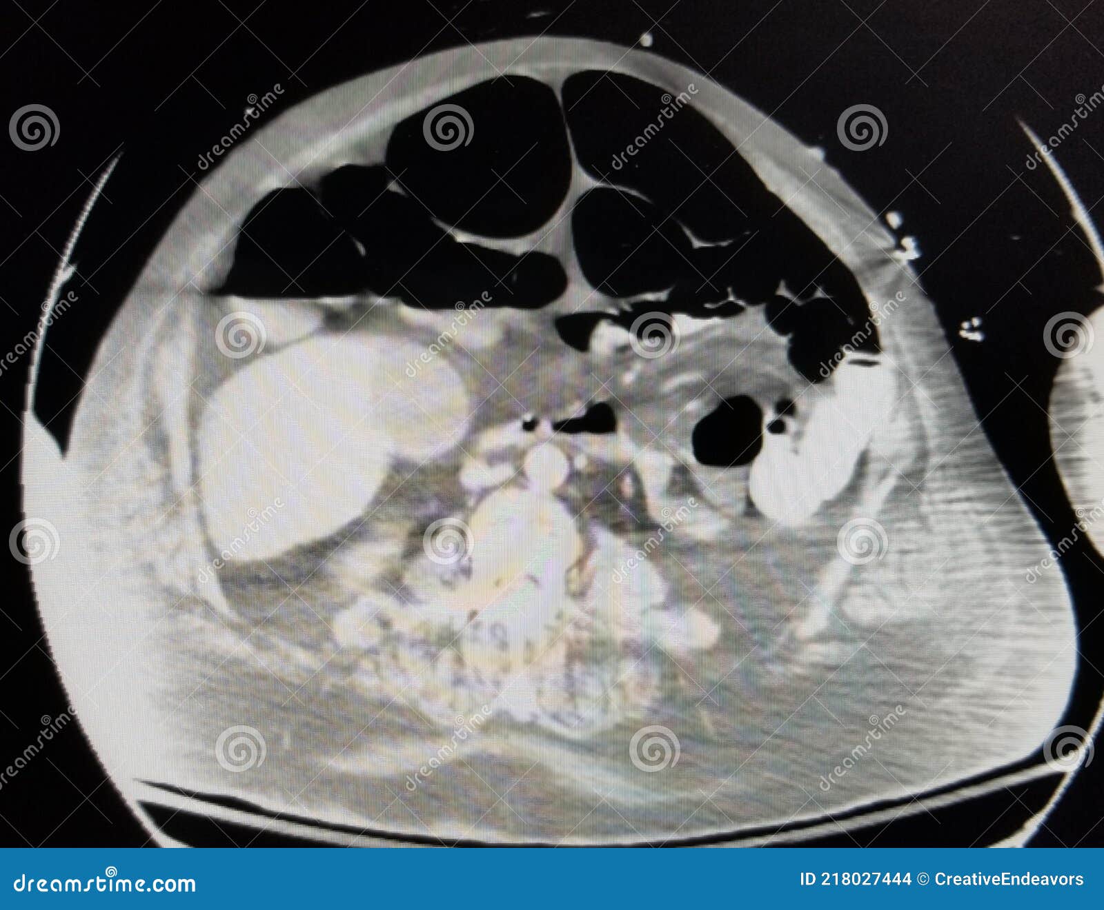 Left Sigmoid Volvulus - CT Scan of the Abdomen Stock Photo - Image of ...
